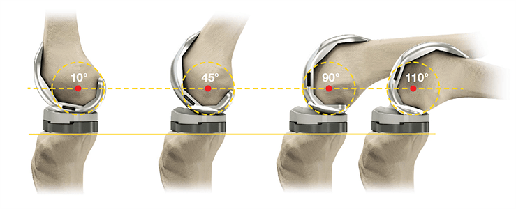 Knee Implant Surgery Melbourne, Malvern & Werribee | MOATI