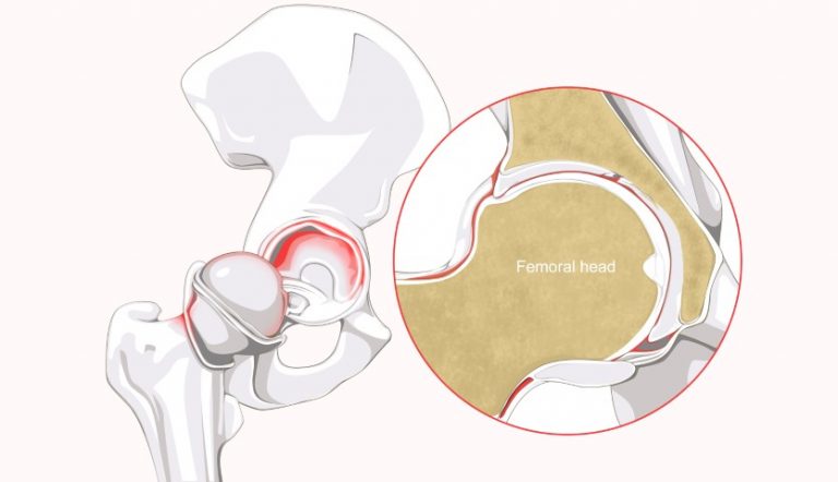 Hip Labral Tear Symptoms, Surgery & Treatment Melbourne | MOATI
